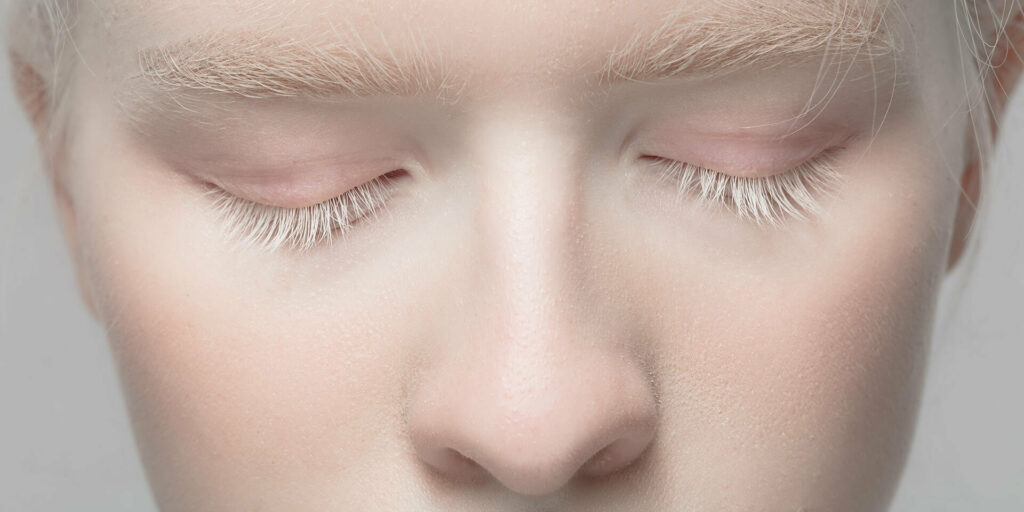 Albinisme: «J'ai le sentiment que beaucoup de choses ont changé ...